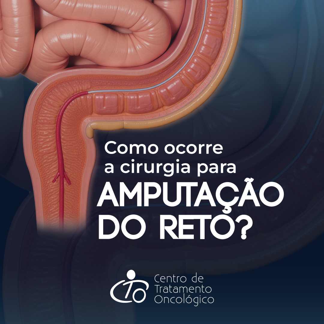 Como ocorre a cirurgia para amputação do reto?