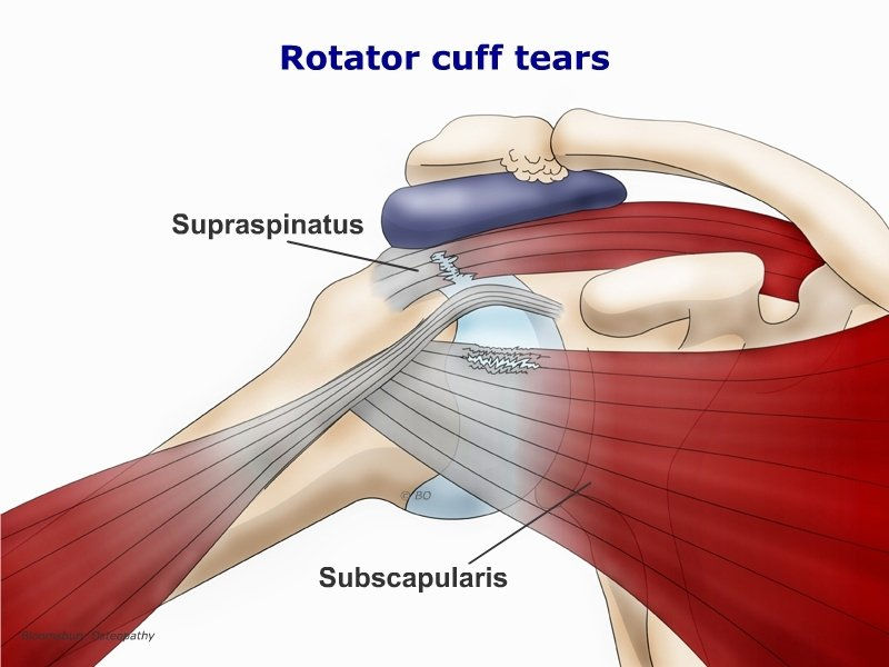 ROTATOR CUFF - PAINFUL SHOULDER