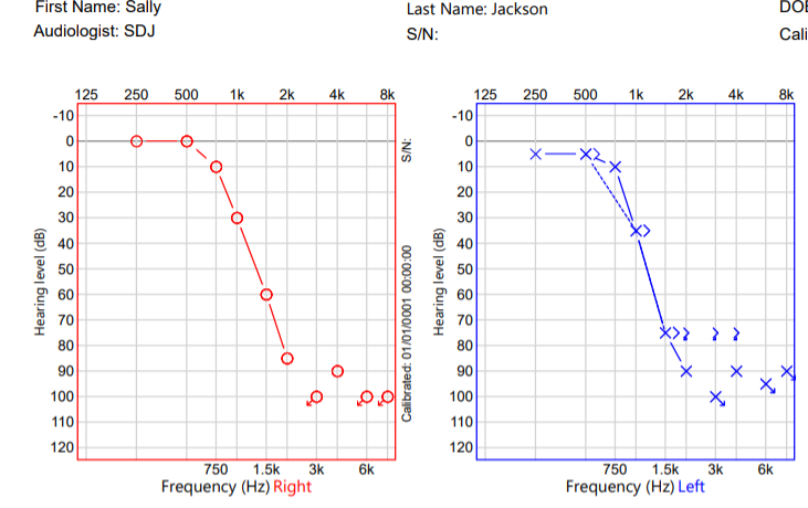 Audiograms - How to Interpret Your Hearing Test Results