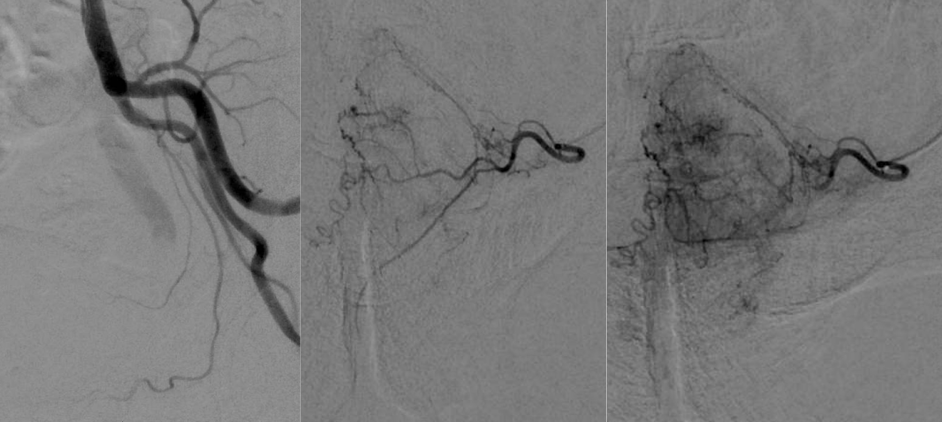 What is Prostate Artery Embolization (PAE)?
