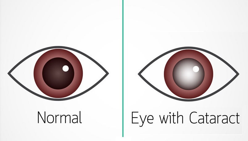Facts About Cataracts
