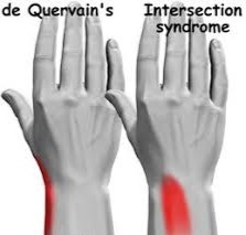 We excel in diagnosing and treating "Intersection syndrome" of hand. So ...