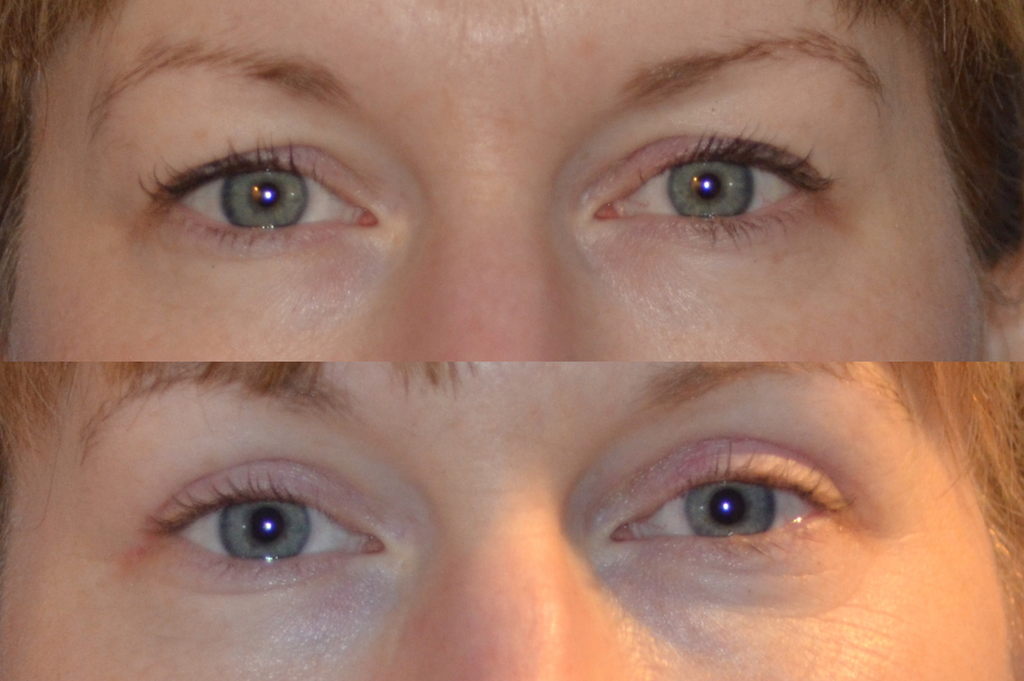 Bump on the eyelid: How to do you distinguish a stye from cancer?