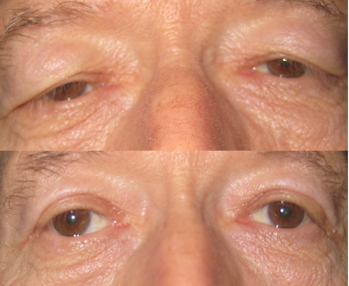 Denver Eyelid Surgery | Blepharoplasty Denver | Eyebag Treatment