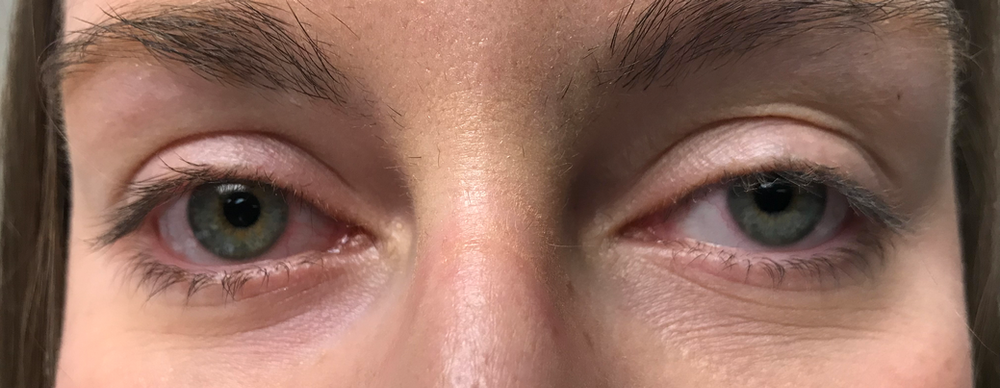 Why do I have ptosis (a drooping eyelid)?