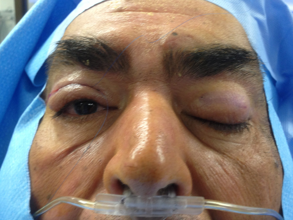 The four things you need to know about a drooping eyelid