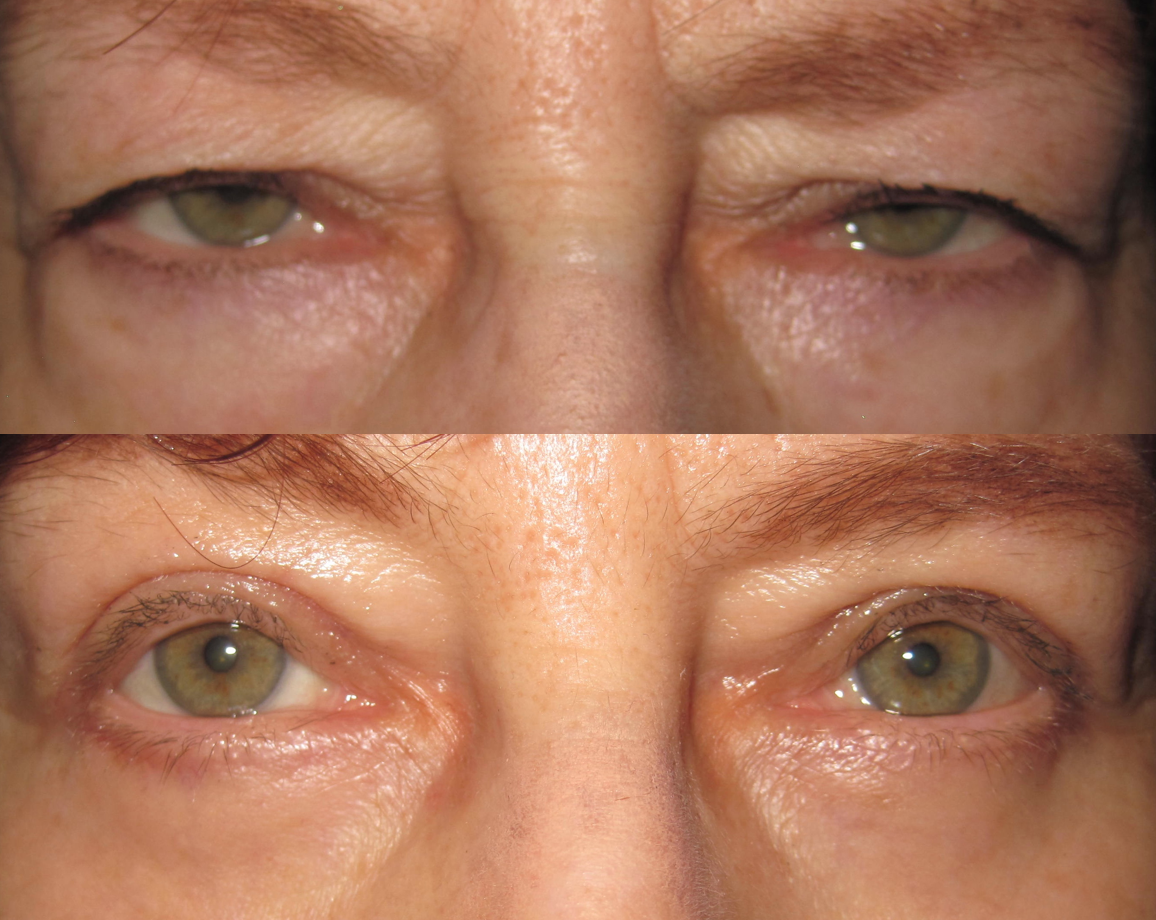 Denver Eyelid Surgery | Blepharoplasty Denver | Eyebag Treatment