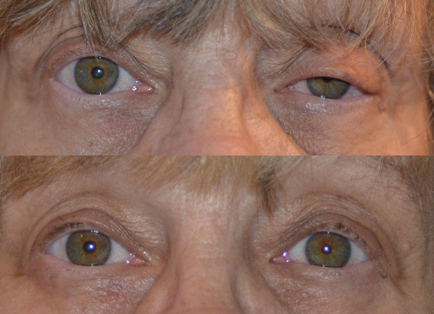 A Denver Eyelid Specialist gives you the definitive guide to ptosis of ...