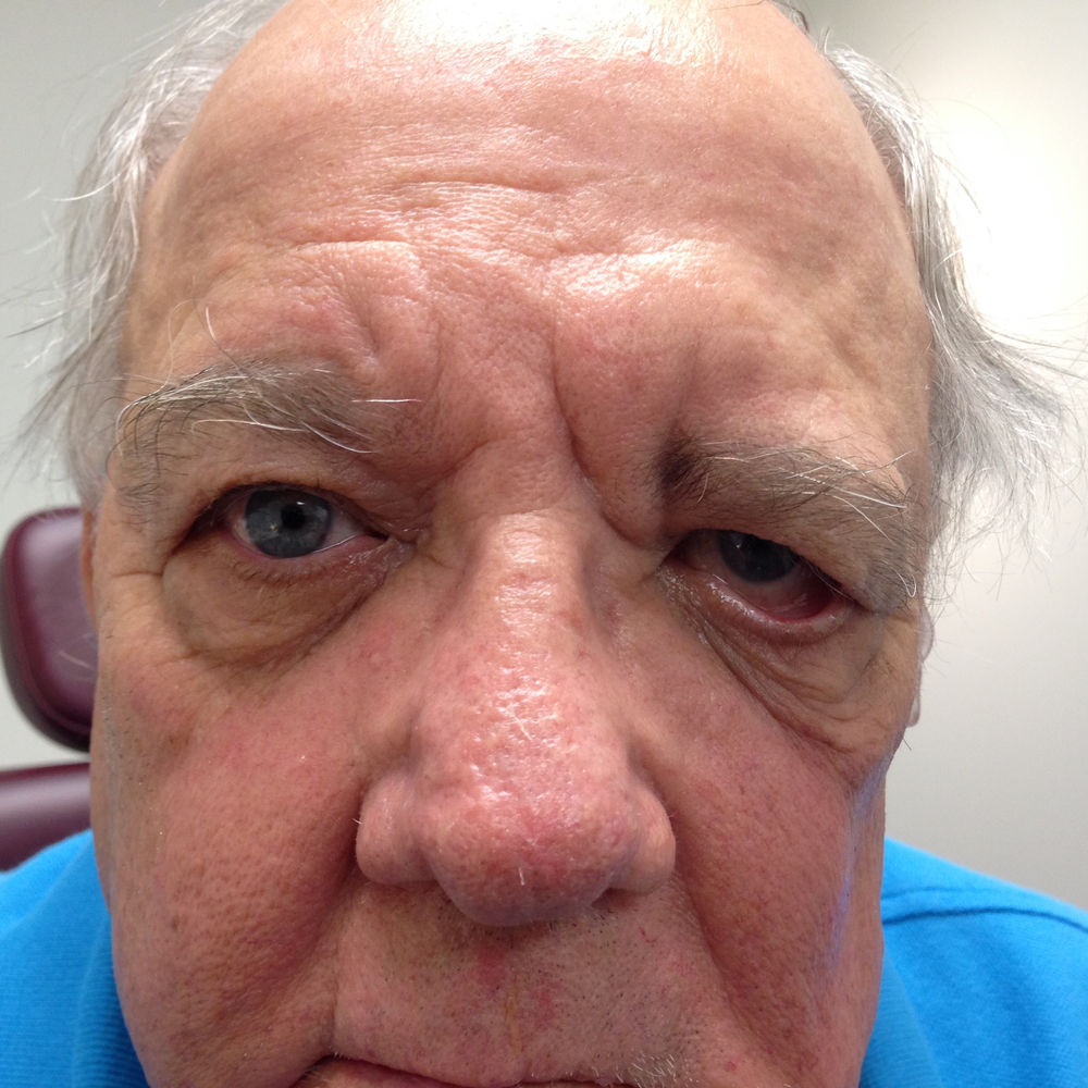 Bell s Palsy What Are The Treatment Options In Denver If You Can t Close Your Eye bell-s-palsy-what-are-the-treatment-options-in-denver-if-you-can-t-close-your-eye
