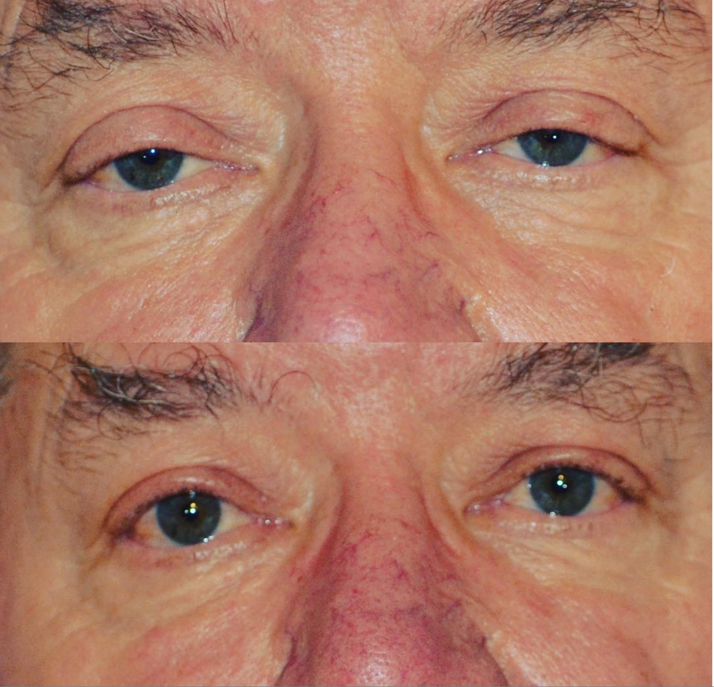 2019 Cosmetic Eyelid Surgery: Distiguishing a drooping eyelid from ...