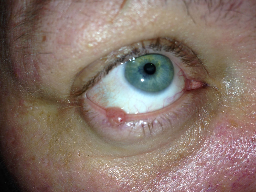How A Denver Oculoplastic Surgeon Treats Skin Cancer On The Eyelid