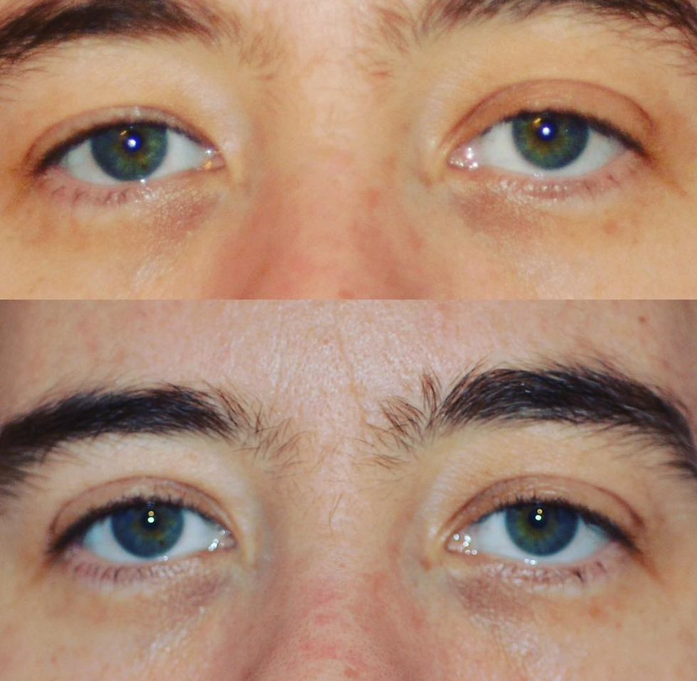 Eyelid Ptosis Repair: A Comprehensive Guide to Treating Drooping Eyelids