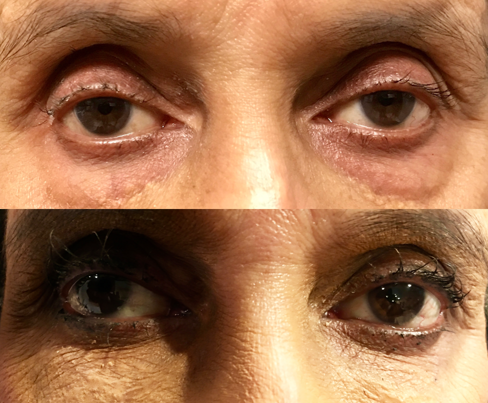 Denver Eyelid Surgery | Blepharoplasty Denver | Eyebag Treatment