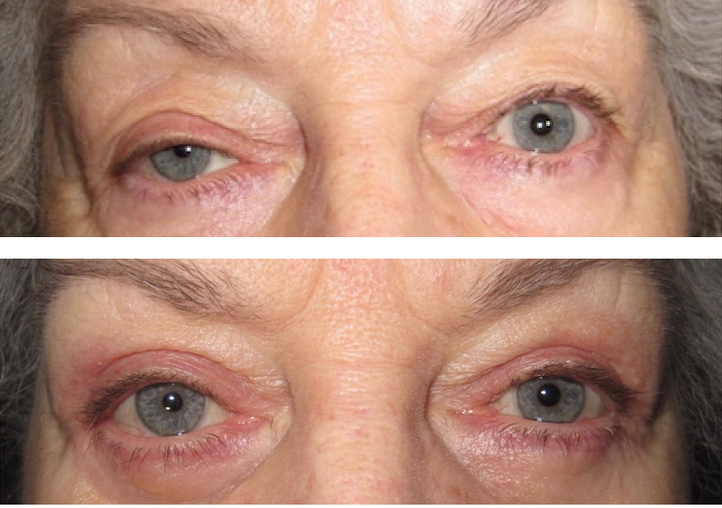Denver Eyelid Surgery | Blepharoplasty Denver | Eyebag Treatment