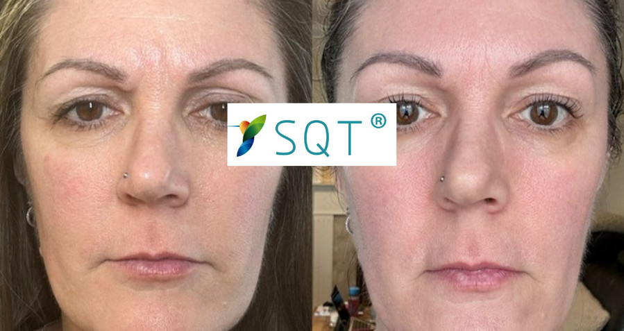SQT Facial with Bio-Microneedling| Ideal Body Med Spa| Westbury NY
