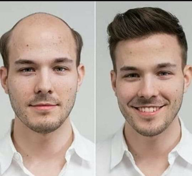 Non-Surgical Hair Fixing in HSR Layout – Flair Hair Fixing