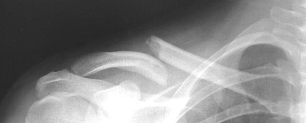 Fratura da Clavícula