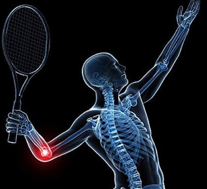 Epicondilite Lateral