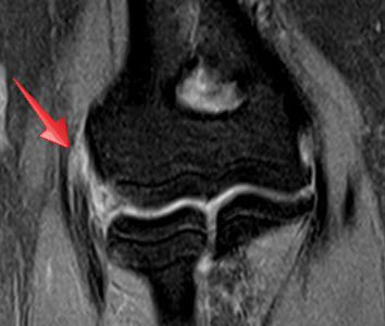 Epicondilite Lateral