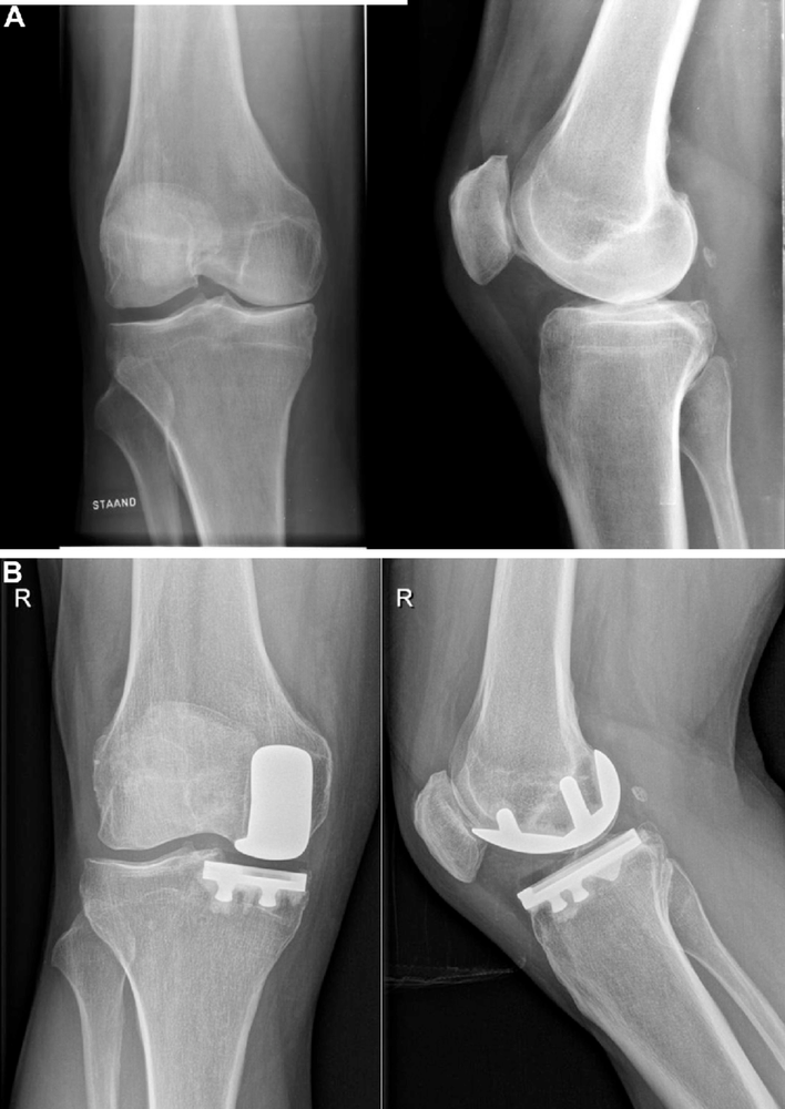 What is a Partial Knee Resurfacing? Is it Better than a Total Knee ...