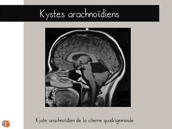 Kystes arachnoïdiens | douleur-riviera