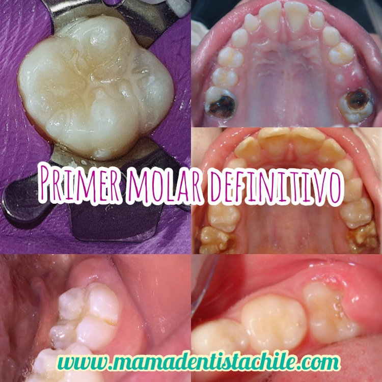Primer Molar Definitivo