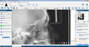 アライナー矯正治療 | デジタルプランニングソフト