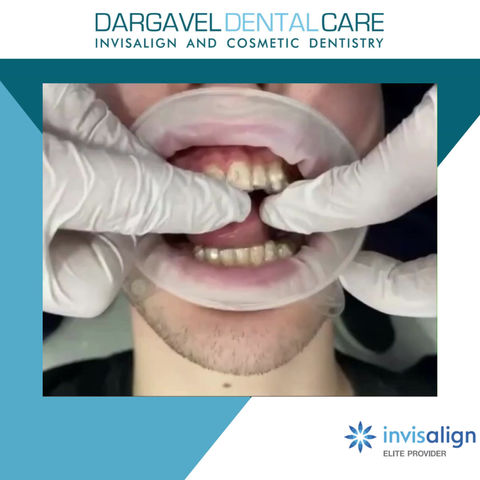 The Invisalign Process - Achieve a Straight Smile Step by Step