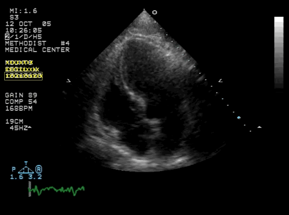 Systolic LV Fcn | Bssp