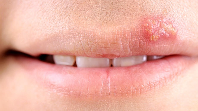 Herpès, un simple bouton?