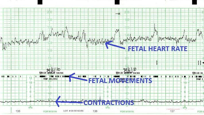 Fetal movements - how much is enough?