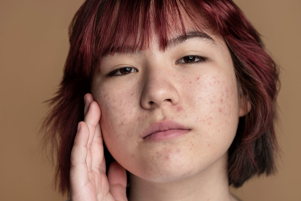 Types of Acne and its Treatments | KINS Clinic