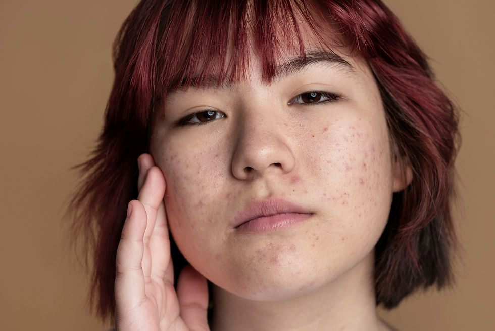 Types of Acne and its Treatments | KINS Clinic