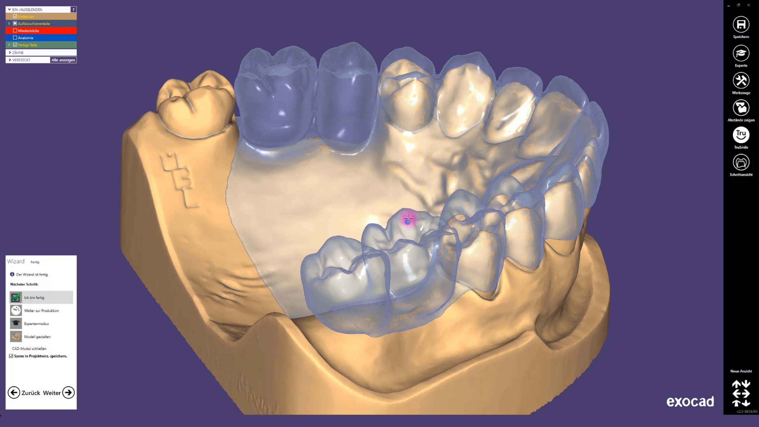 Snap-On-Schienen im exocad