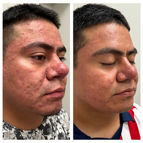 rosacea cheeks