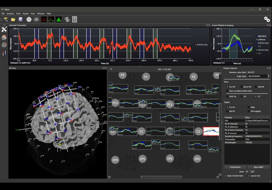 Why Primitive Reflexes Matter for Healthy Ageing
