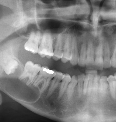 Dr Alexandre Viau - Extraction des dents de sagesse
