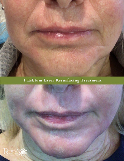 Erbium Laser Resurfacing | Renove