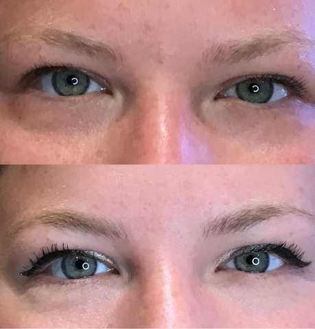 Ultherapy Facial Skin Tightening | Renove