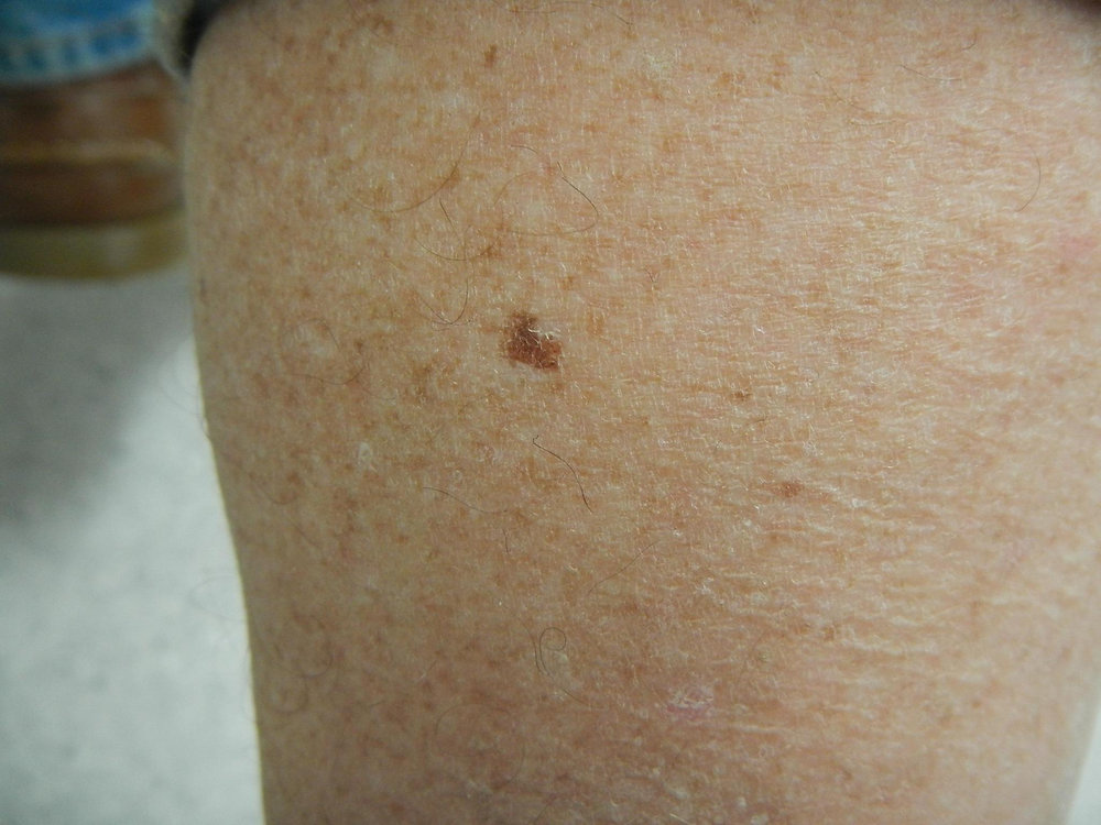 Melanoma Insitu (Calf)