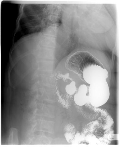 Barium Swollow Meal | imagingandultrasound