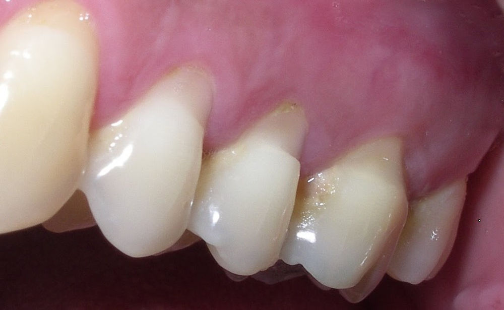 HIPERSENSIBILIDAD DENTINARIA