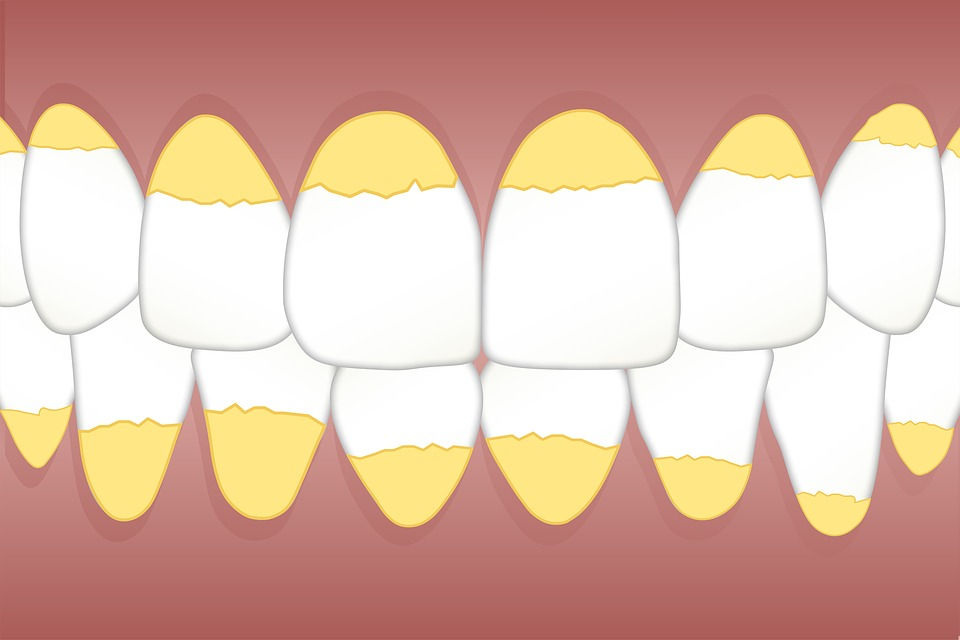 CALCULO DENTAL... ¿QUE ES?