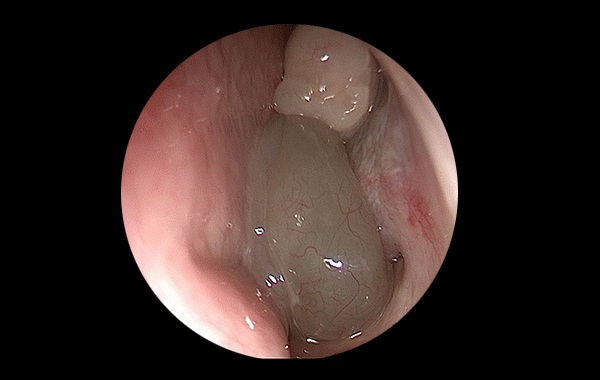 Polipose Nasal Causas Sintomas E Tratamento