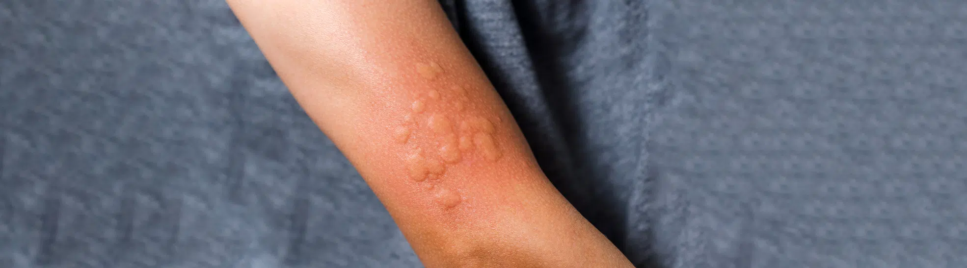 Understanding Chronic Pain in Mast Cell Activation Syndrome (MCAS)