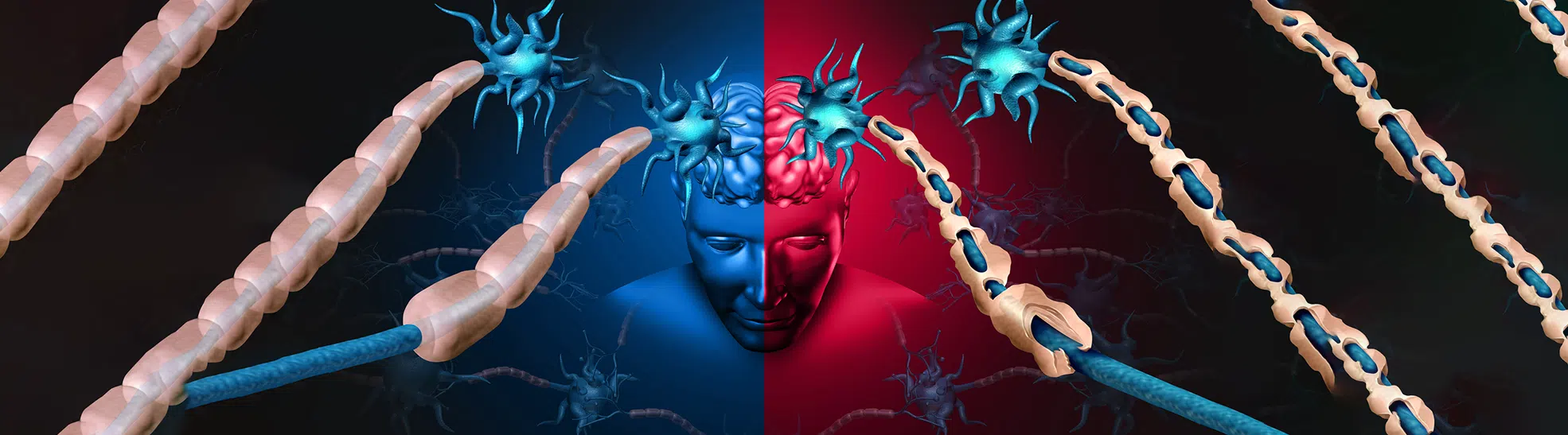 Chronic Pain in Multiple Sclerosis