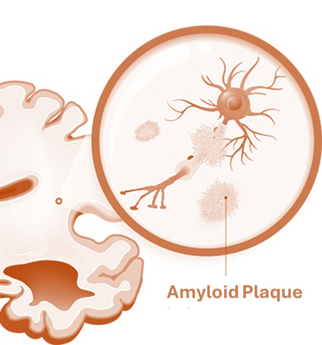 Major Doubt Cast on Amyloid Hypothesis in Alzheimer's Disease!