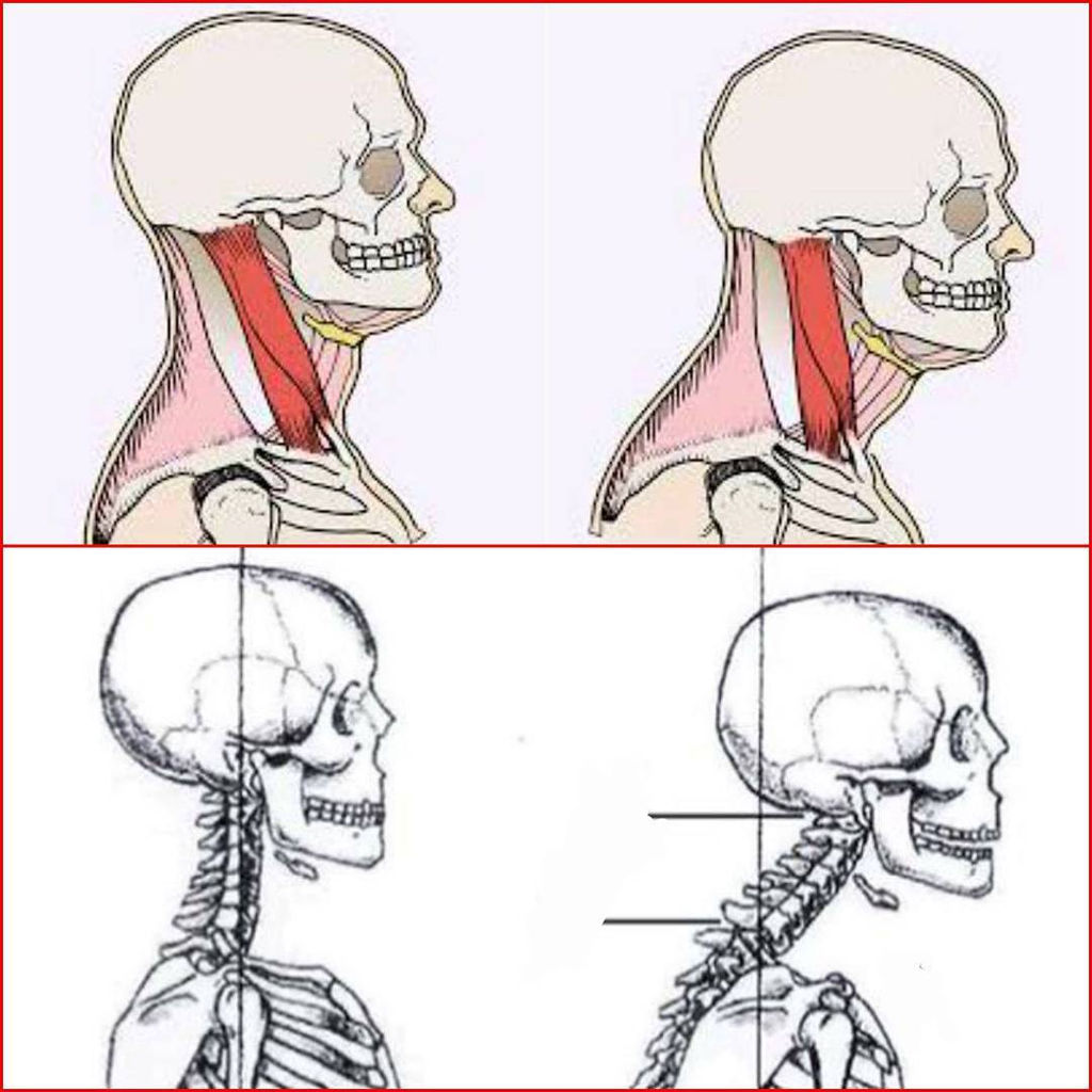 Contracturas Cervicales