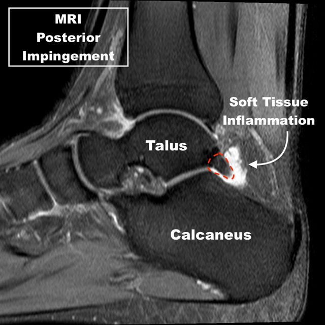 Os Trigonum Syndrome