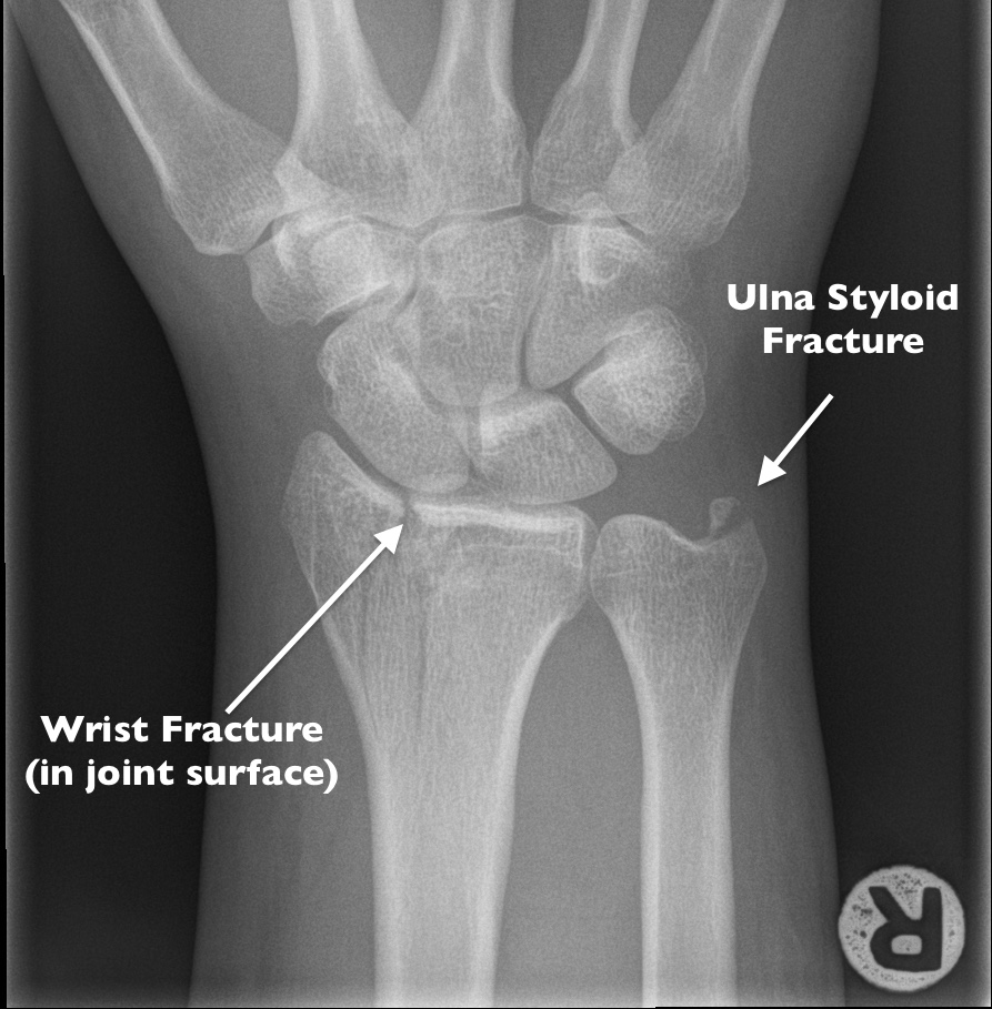 MLB Dodgers - Justin Turner: When Will He Be Ready?